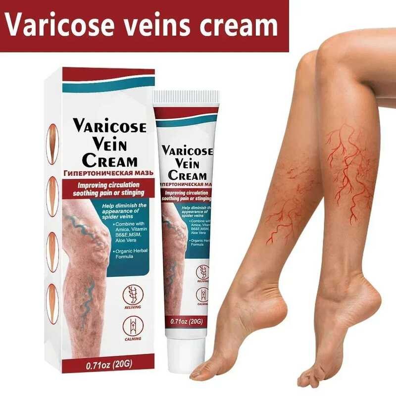 Varicose Effective Vein Relief Cream Eliminate Vasculitis Phlebitis ...