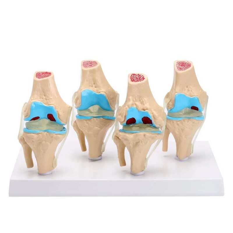 Knee Isang Joint 4-Stage Osteoar Thritis Anatomical Model Set Ng 4 ...