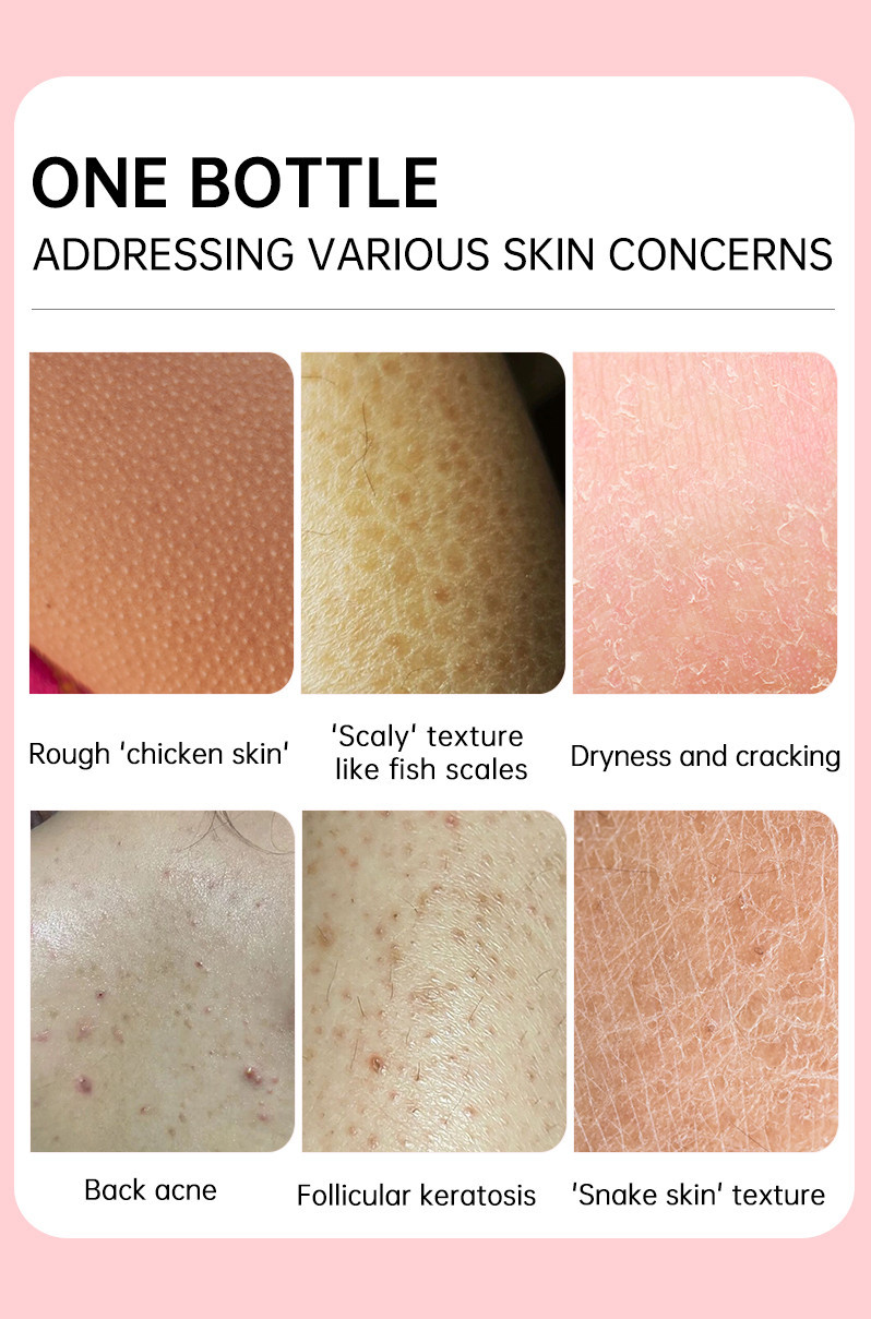 Body Cream Chicken Skin Removal Treatment Keratosis Pilaris Lotion ...