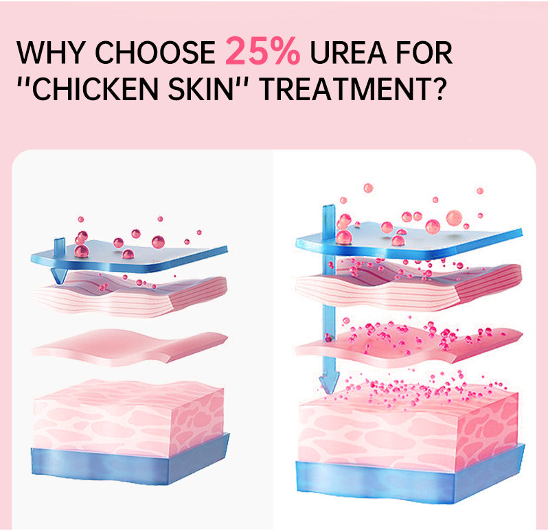 Body Cream Chicken Skin Removal Treatment Keratosis Pilaris Lotion ...