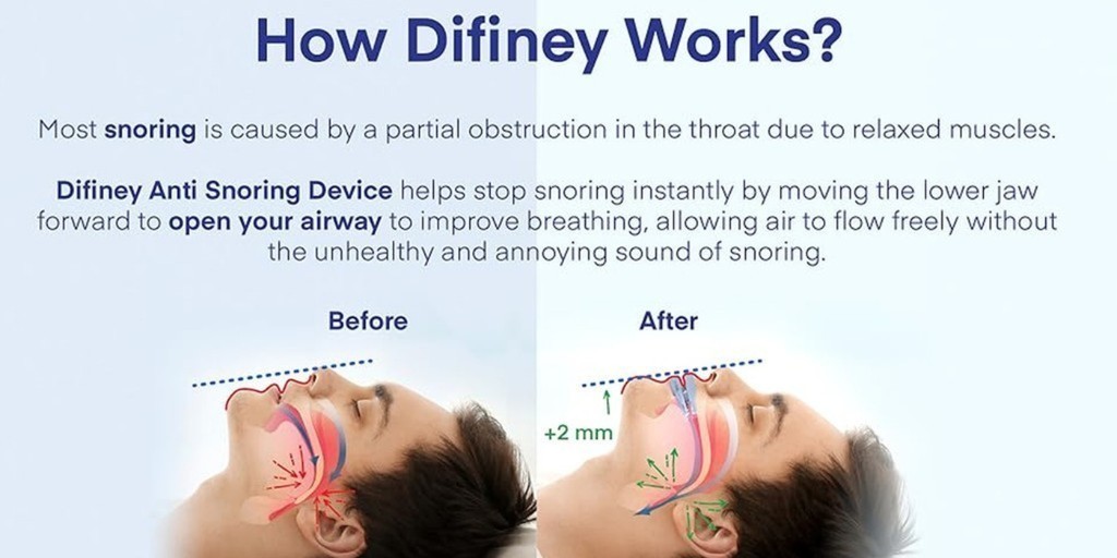 Snoring Stopper An Effective Solution for Anti-snoring Devices To ...