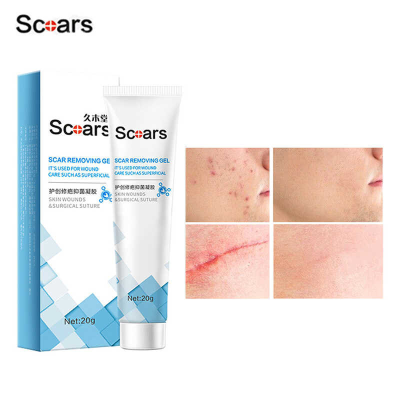20g Scars remover for old scar on leg acne marks Injury scars Burns and ...