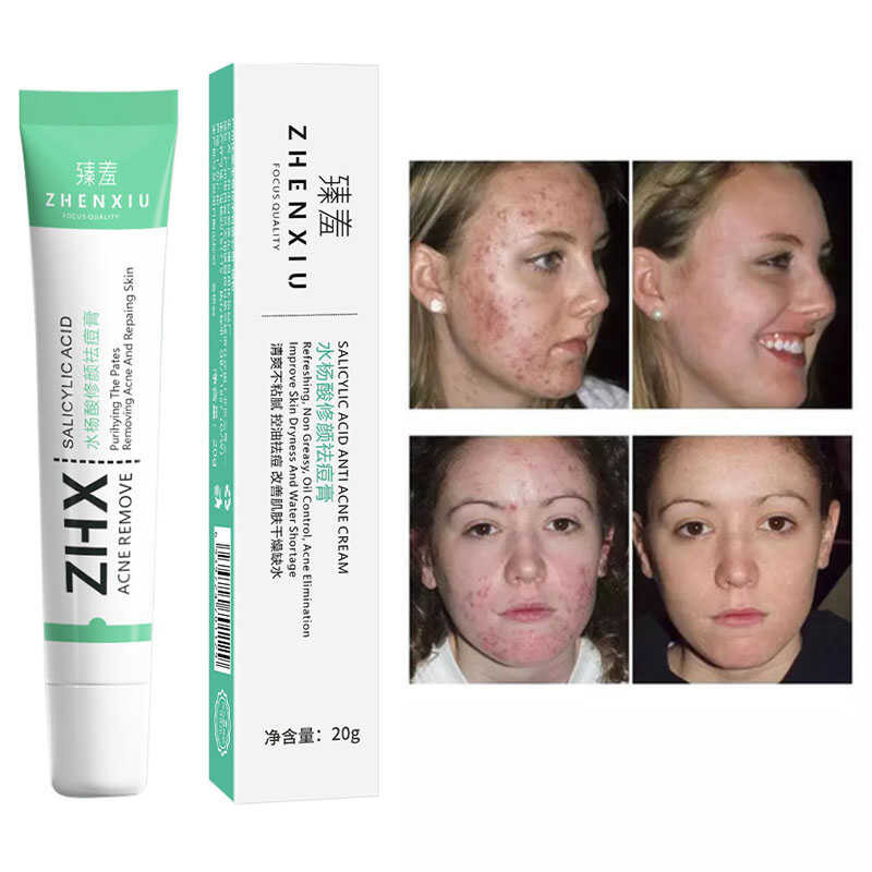 Chamomile Herbal Removal Acne Traditional Chinese Medicine Treatment ...