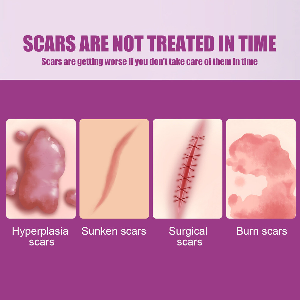 Scar Remover Cream For Face Body Scar Acne Treatment Scar Removal ...