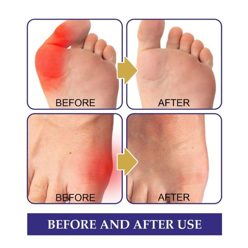 SouthMoon Anti Bunion Sticker Gout Pain Relief Lumbar Hallux Arthriti ...