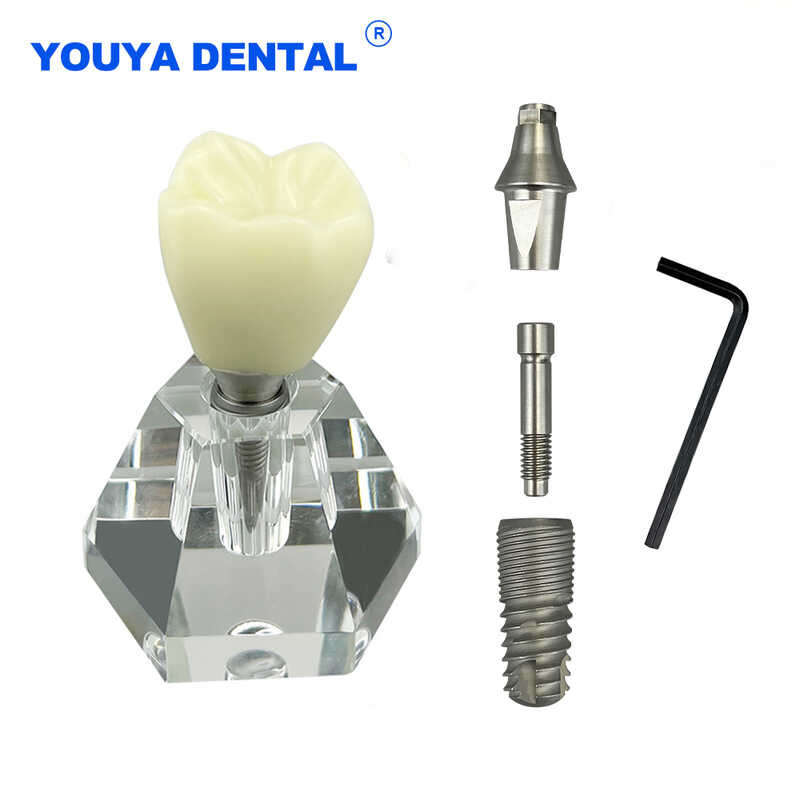 Dental Crystal Implant Model Teeth Communication Transparent Dental ...
