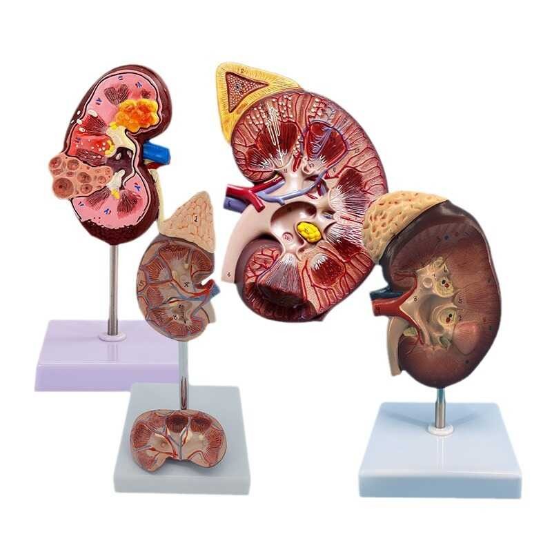 Human Kidney Model Kidney Anatomy with Adrenal Enlargement Model ...