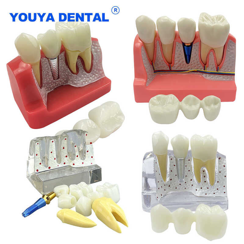 Dental Model 4Times Implant Resin Module Tooth Analysis Crown For ...