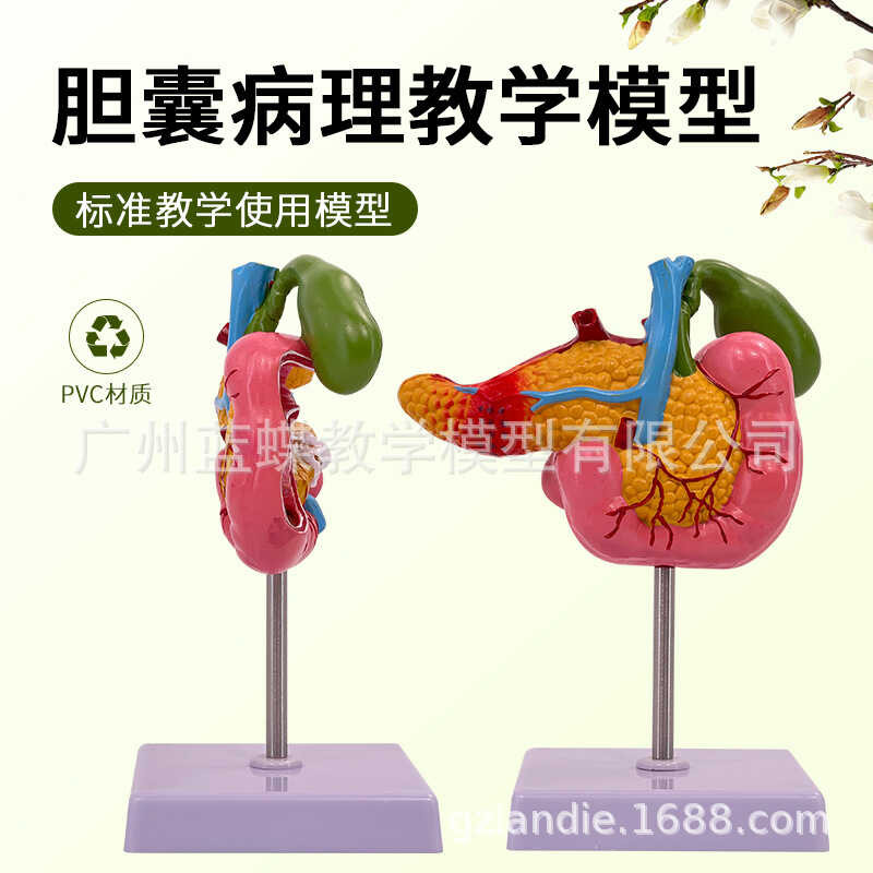 Medical Pancreatic Duodenal Gallbladder Pathological Model Gallstone ...