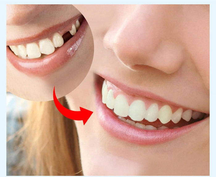 Perfect smile dentures snap-on dentures Simulation teeth braces Natural ...