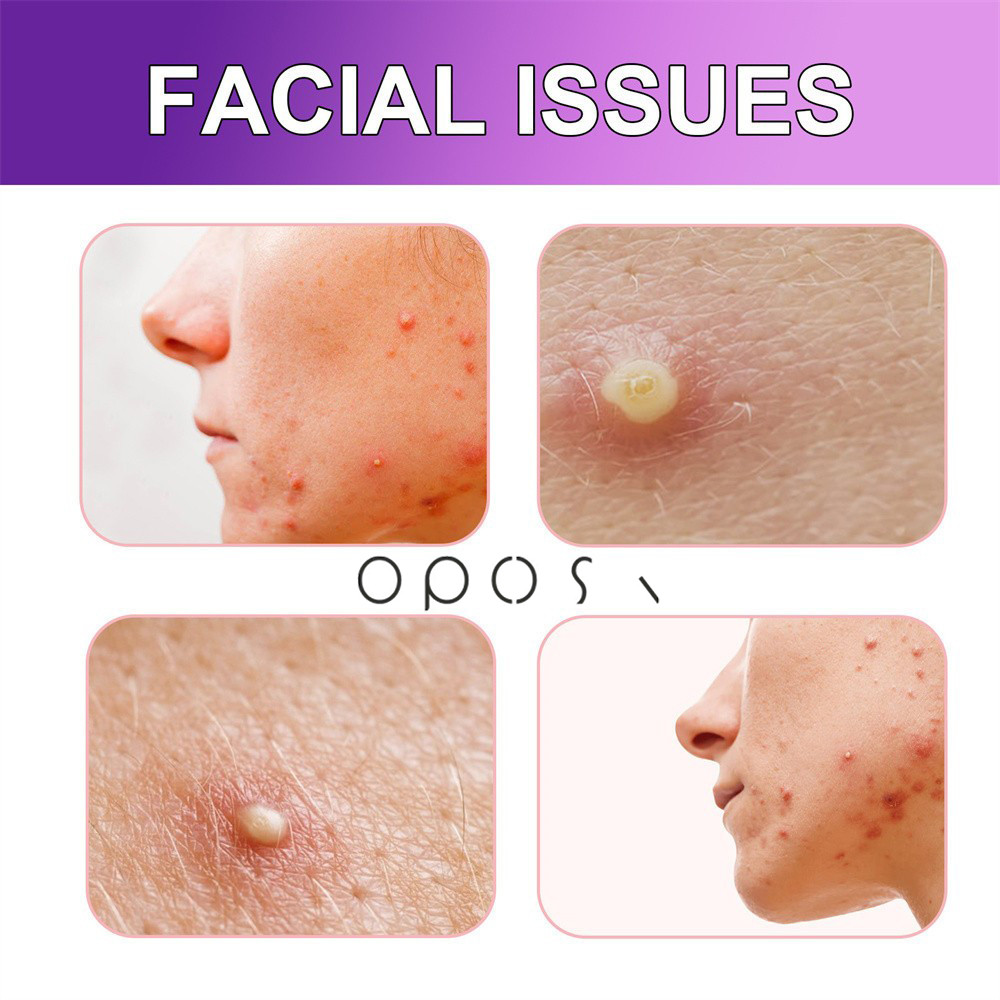 【Original Official】Jaysuing Star Shaped Acne Removal Pimple Patches ...
