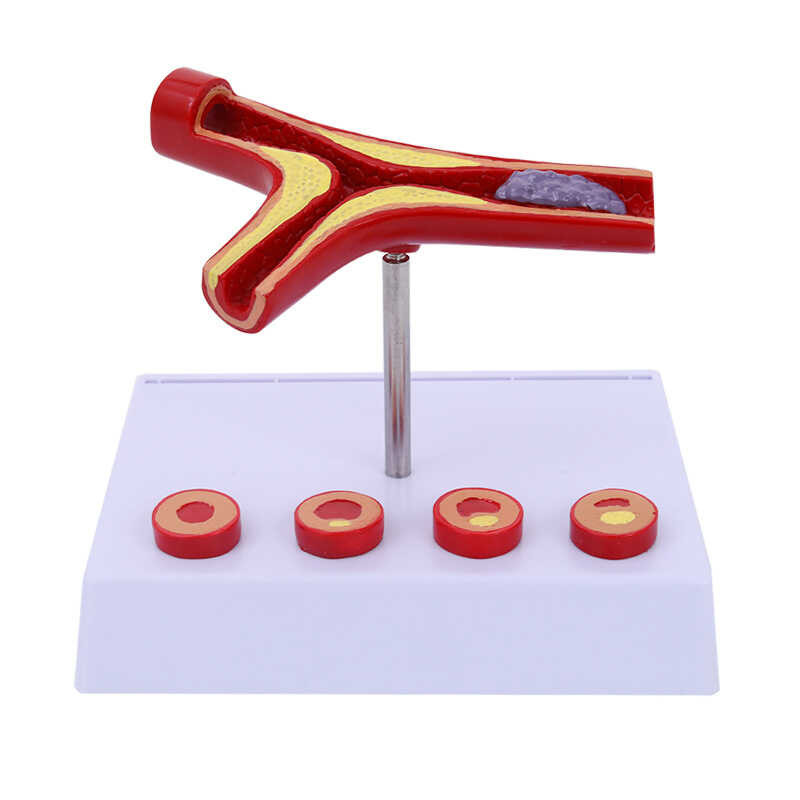 Coronary artery atherosclerosis model, elderly heart model, thrombus ...