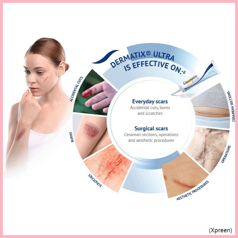 Australia Dermatix Ultra Gel Scar Removal Cream Old Scars Acne Scar ...