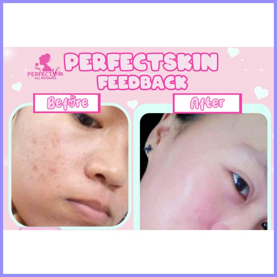 ☪ Perfect Skin Extra Strength Rejuvenating Kojic Micro Peeling Soap ...