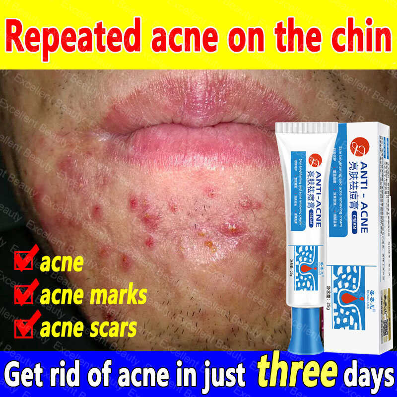 2025 Acne Treatment Set/Pimple Remover/Gamot Tagyawat mukha/pimples ...
