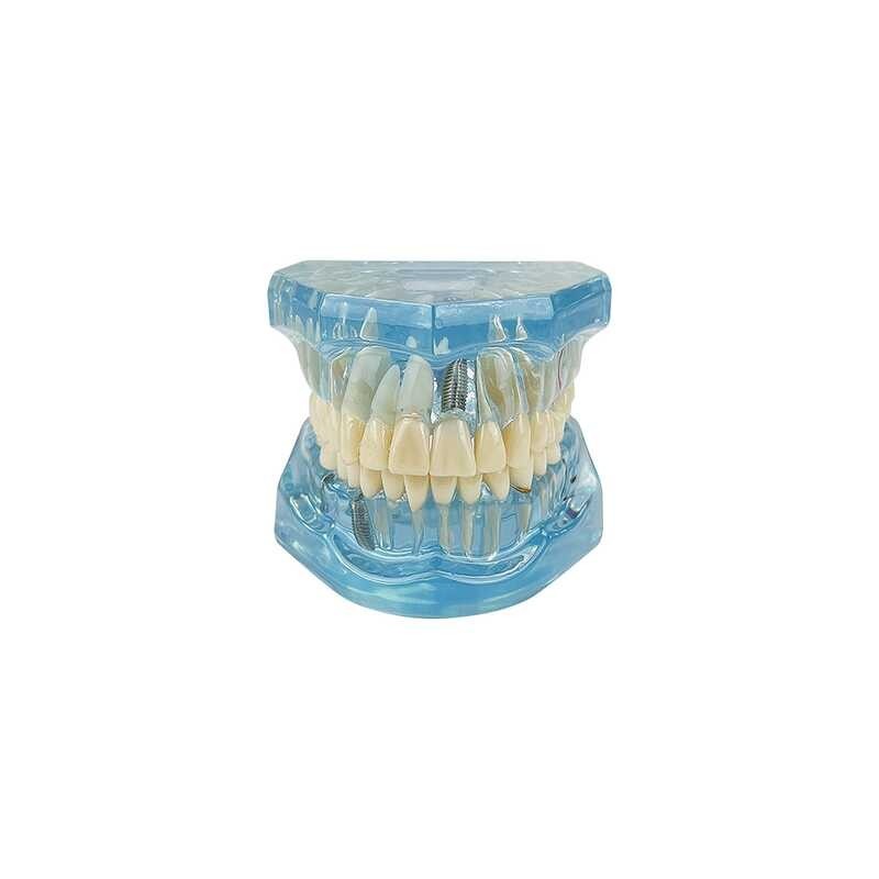 Implant Standard Disease Dentist Studying Demo Dental Typodont Model ...