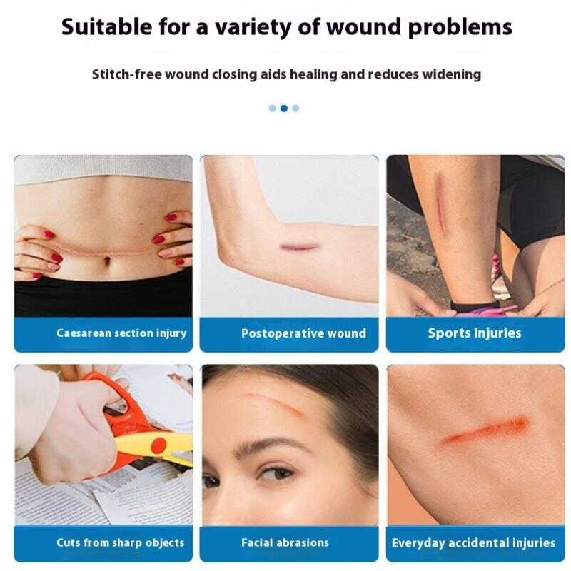 Trektribe 1Pc Zipper Tie Wound Closure Patch Band-Aid Fast Suture ...