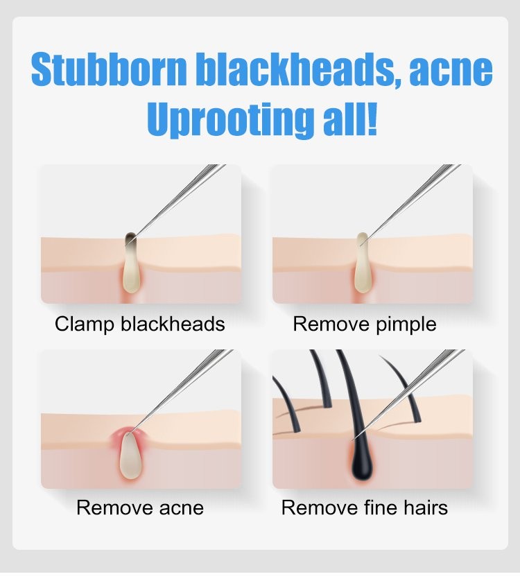 A set Stainless Steel Acne Black Heads Remover Tool/Cell Tweezers/Acne ...