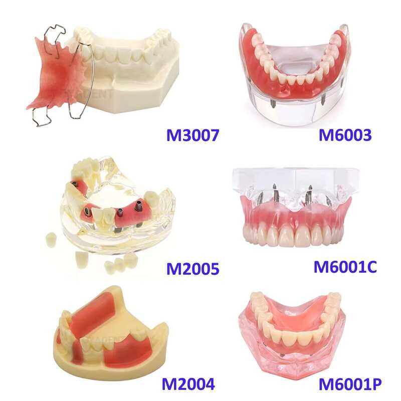 Teeth Dental Implant Model Implant Overdenture 2/4 Implant Upper Lower ...