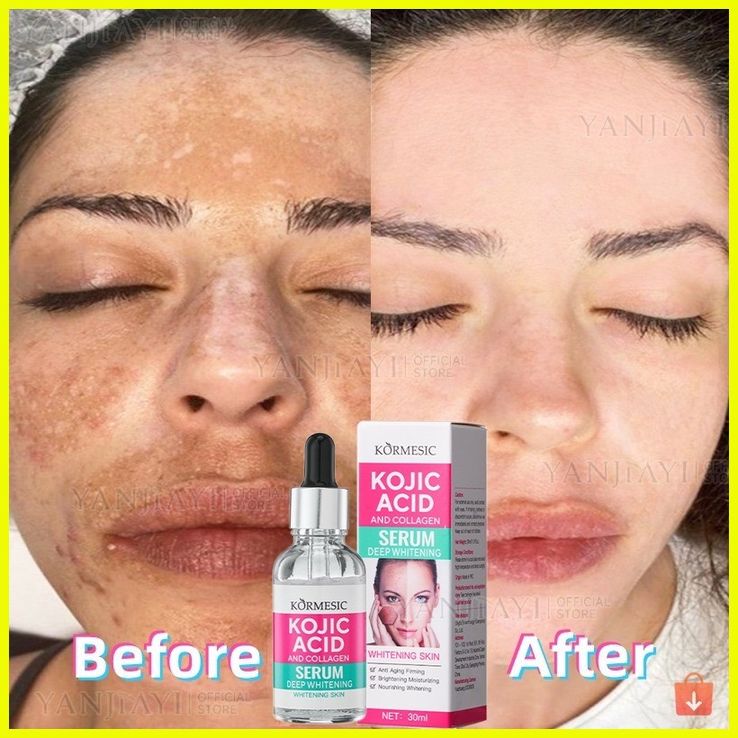 Kojic Acid Collagen Serum Deep Whitening Skin Anti Freckle Remove Dark ...