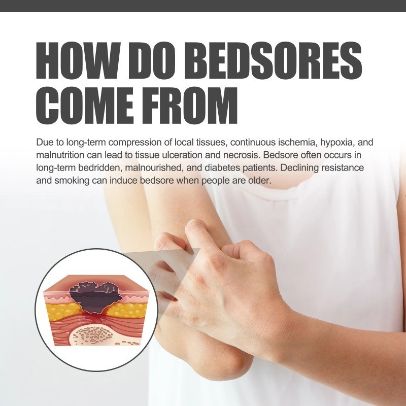 Bedsore Treatment Ointment Repair Rot Necrotic Skin Antibacterial ...