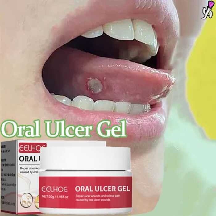 Canker Mouth Sore Gel 30G Treatment Ointment Ulcer Pain Relief Anti ...