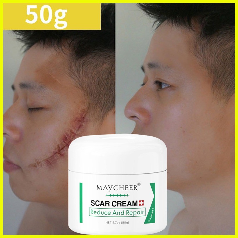 ஐ ¤ Effective Best Scar Remover Cream for New Old Scars on Legs Face ...