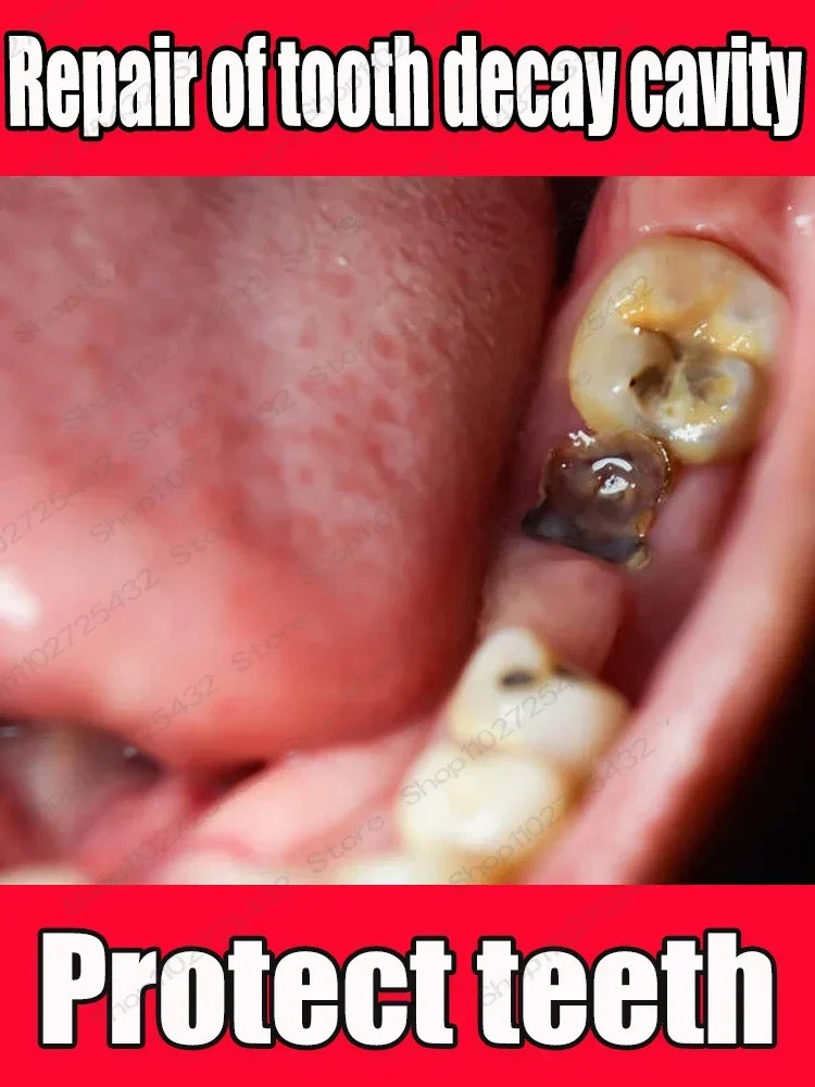 Dental Caries Repair Serum Prevent Tooth Decay Protect Teeth Remove ...
