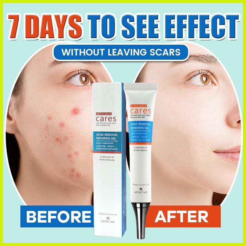 ☃ Acne remover cream Pimple eraser Pimple marks remover Moisturizer ...