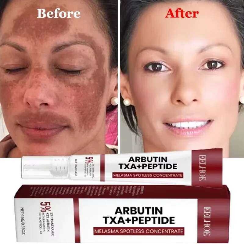 Powerful Spot-Removing Whiten Cream Brighten Skin Fast Eliminates ...
