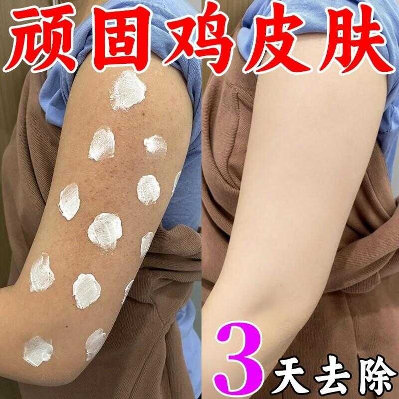 Chicken Skin Pimples Keratosis Pilaris Children's Body Wash Neck ...