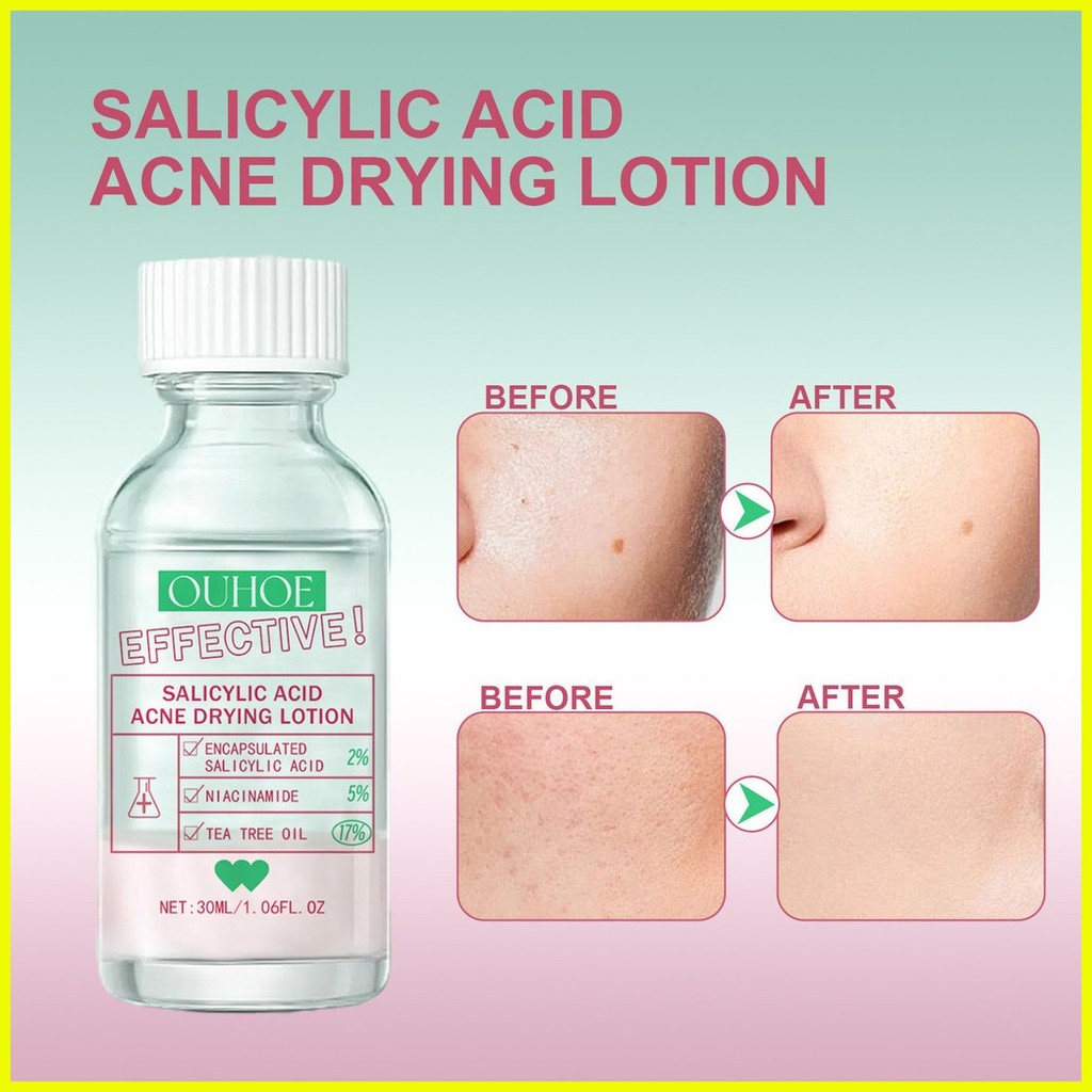 【BUY 1 TAKE 1】Pimple Warrior Salicylic Acid Acne Drying Lotion - Acne ...