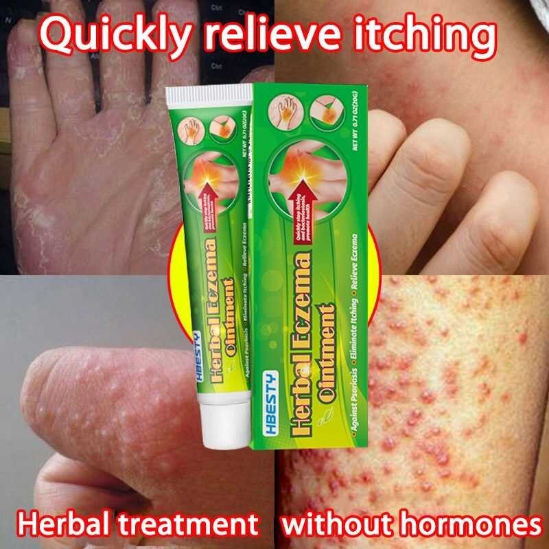MGA EFFECTIVE Psoriasis Remover Indigenous Medicinal Ointment ...