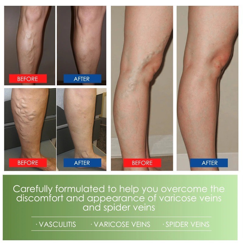 Effective Varicose Vein Relief Cream Eliminate Dilated Vasculitis ...
