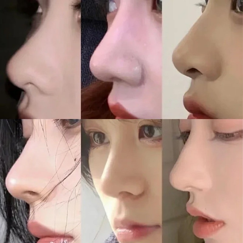 Thermoplastic Nasal Splint - Self Shaping Nose Clip - Low Temperature ...