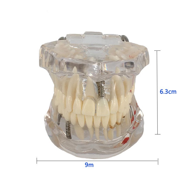 Removable Tooth Model Implant Dental Studying New Dental Model Tooth ...