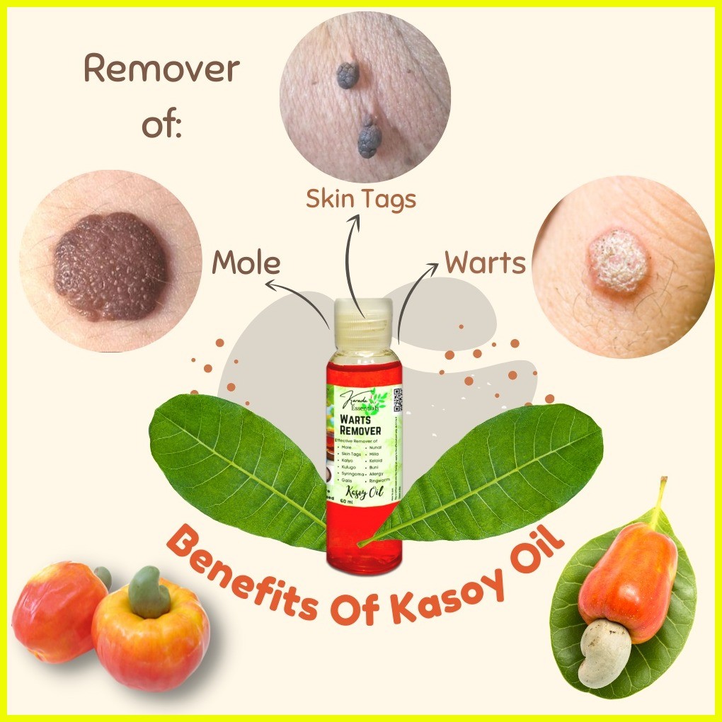 Organic Skin Tag Mole Warts Nunal Kulogo Solution Fast Effective ...