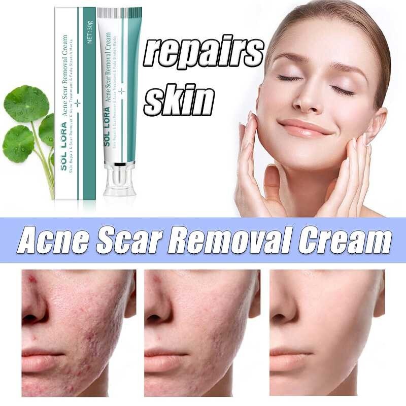 SOL LORA 30ml iskarminador krim orihinal na pagkaalis ng scar stretch ...