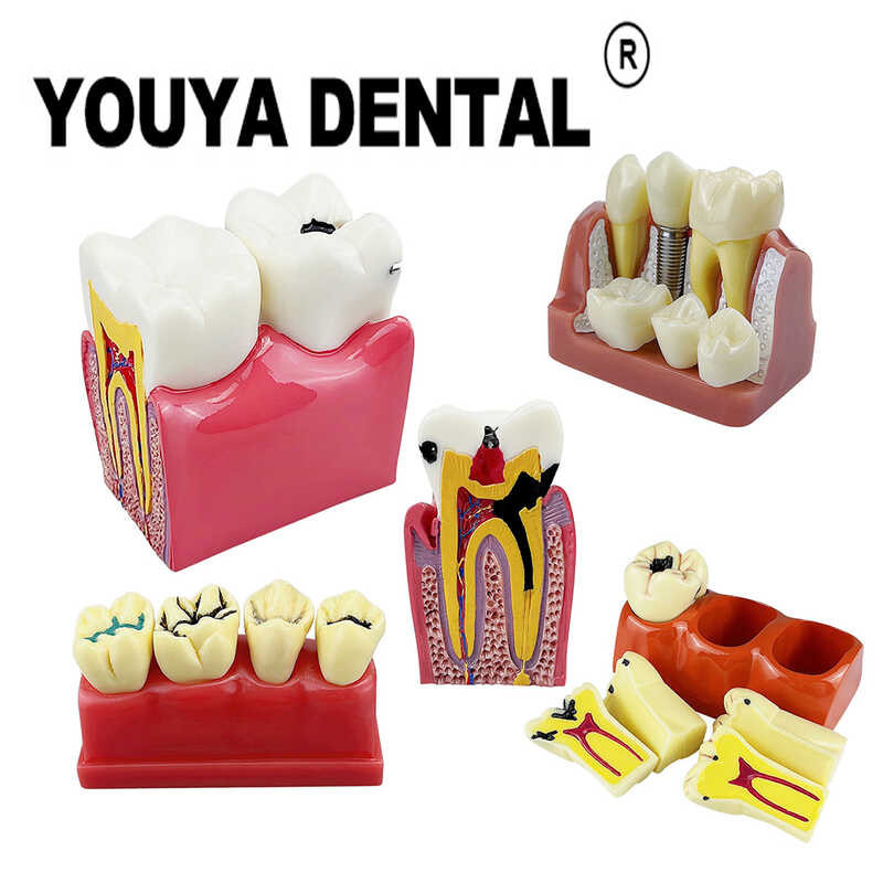 Dental Study Models Teeth Implant Para Sa Dentist Technician Student ...