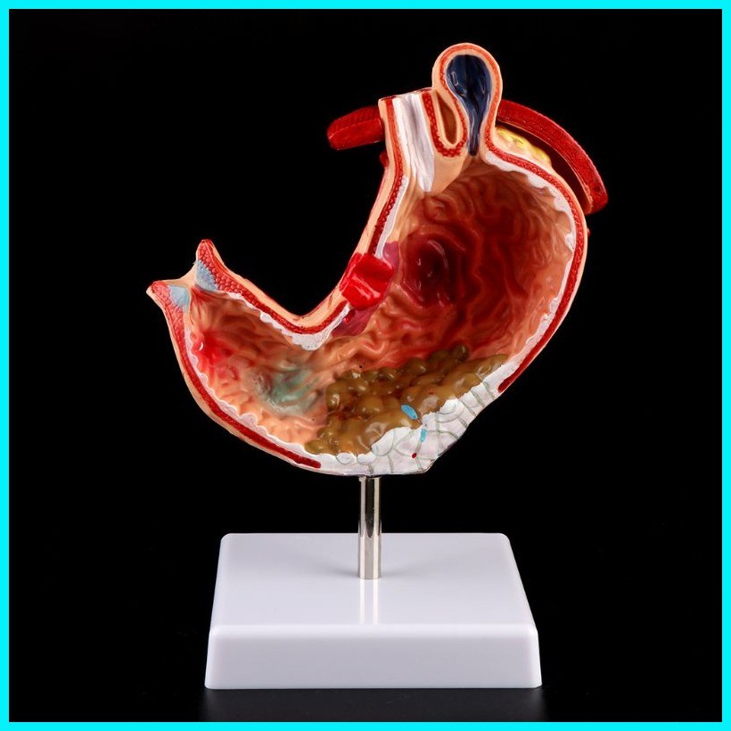 RUNUN Human Anatomical Anatomy Stomach Medical Model Gastric Pathology ...