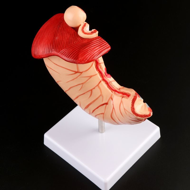 RUNUN Human Anatomical Anatomy Stomach Medical Model Gastric Pathology ...