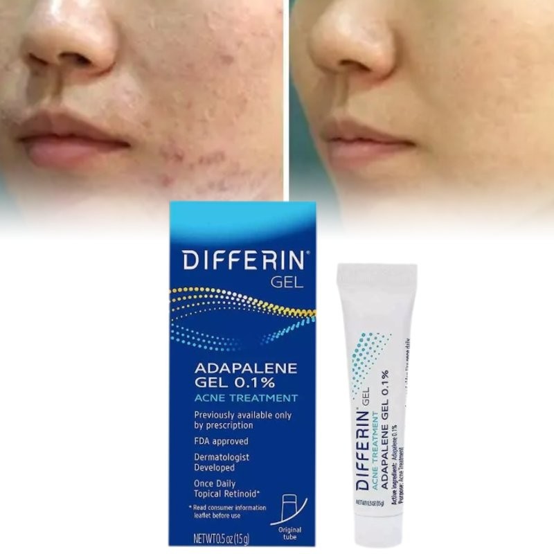 Treatment Differin Acne Gel Premium Retinoid Gel For 15g Prevention ...