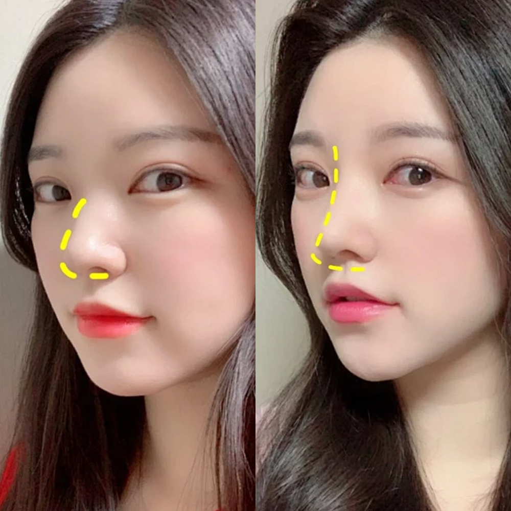 Low Temperature Thermoplastic Nose Splint - Nose Job Rhinoplasty Splint ...