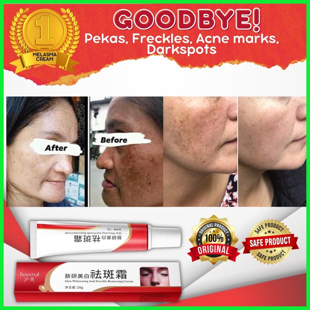 ORIGINAL Melasma Cream Pekas Remover Whitening Glass Skin Anti Freckles ...