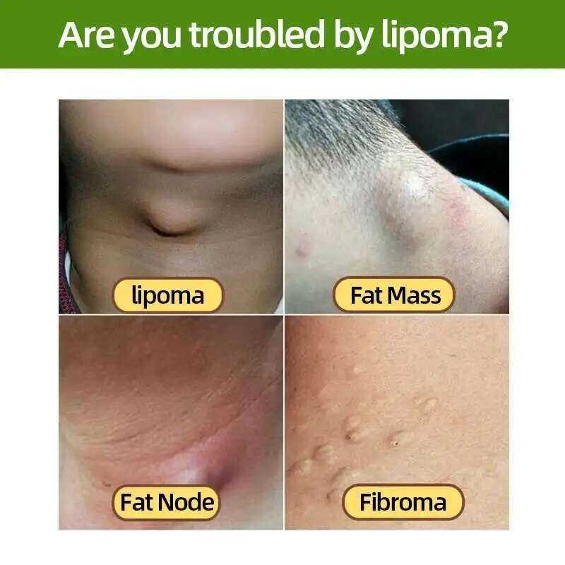 Lipoma Remover Treatment Cream Fat Mass Herbal Medicine Plaster Apply ...