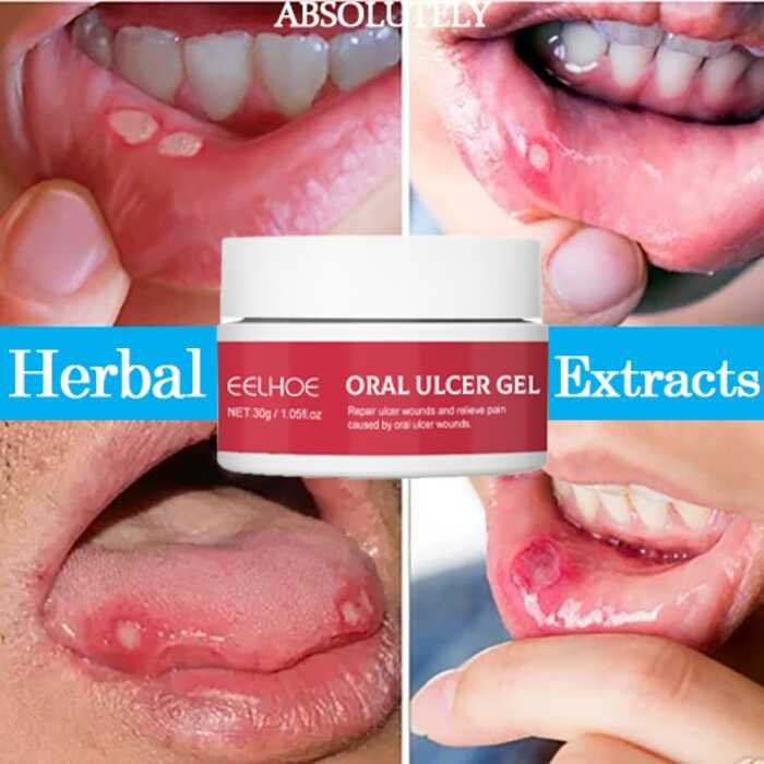 solution mouth ulcer treatment medicine debacterol canker sore gamot ...