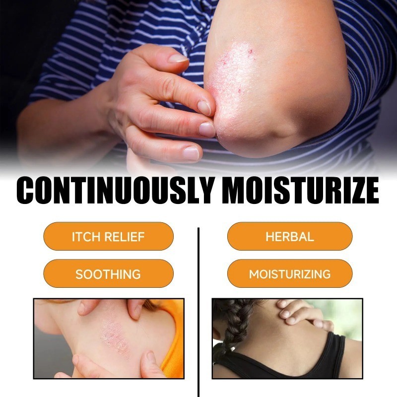 Seborrheic Dermatitis Spray Psoriasis Eczema Fungal Treatment Repair ...