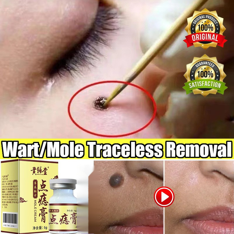APGAR nevus facial nevus removing ointment Mole Warts removal cream ...