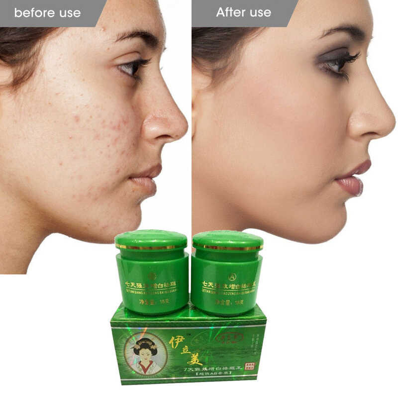 COD Whitening Anti Freckle Melasma Bleaching Skin Care Pigment Face G ...