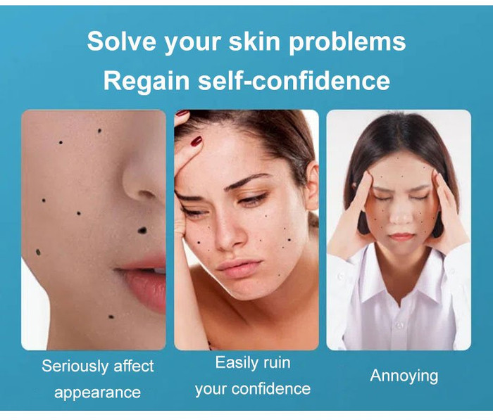 Mole Spotting Cream/Mole Removal Wart Removal Without Stains Flesh Spur ...